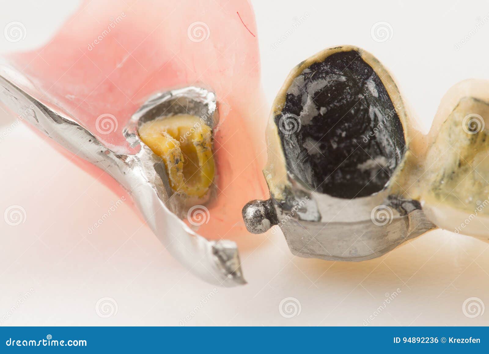Clasp Prosthesis with Lock Fixation Stock Photo - Image of orthodontist ...