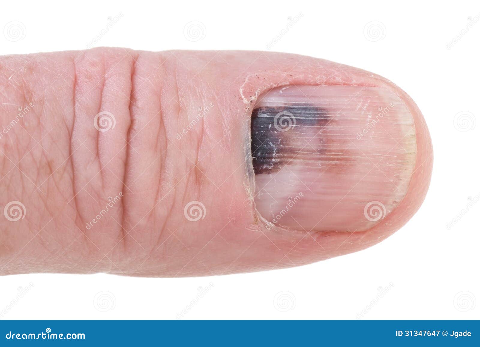 Clavo Contusionado Del Finger Imagen de archivo - Imagen de dedo ...