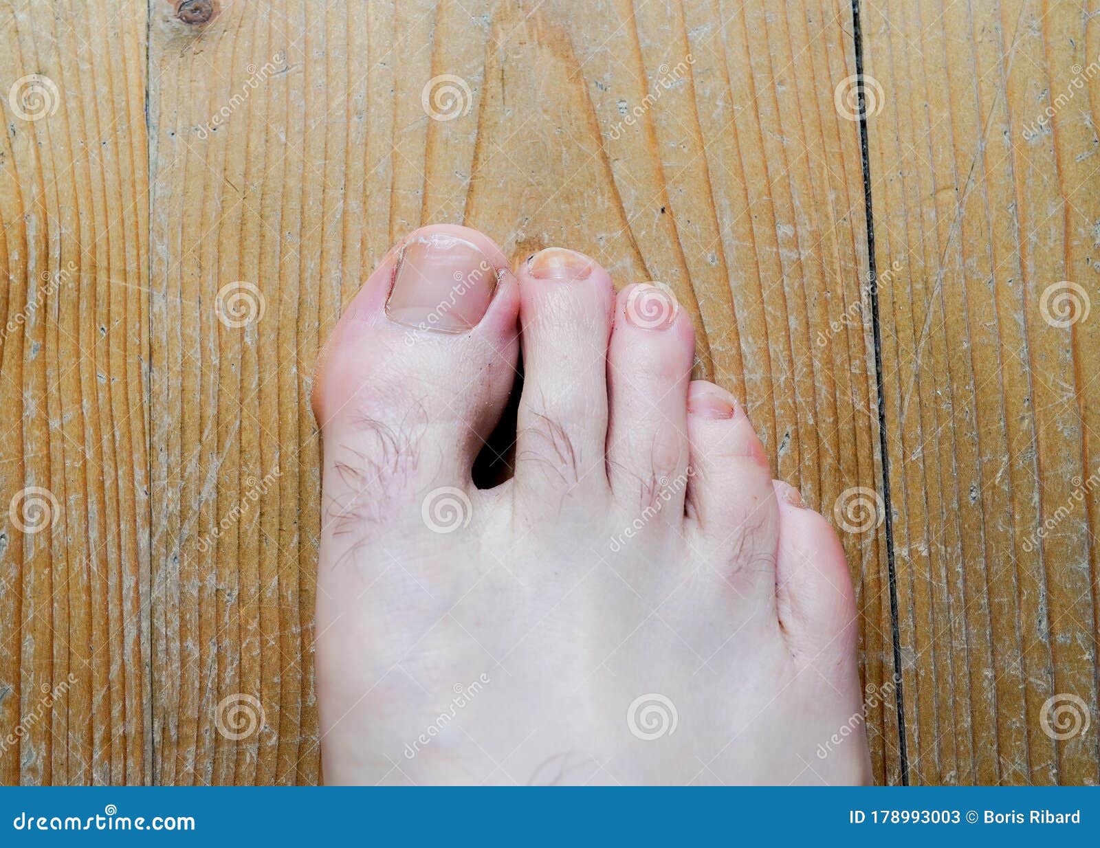 Clavo De Pie Humano Roto Y No Sano Imagen de archivo - Imagen de ...