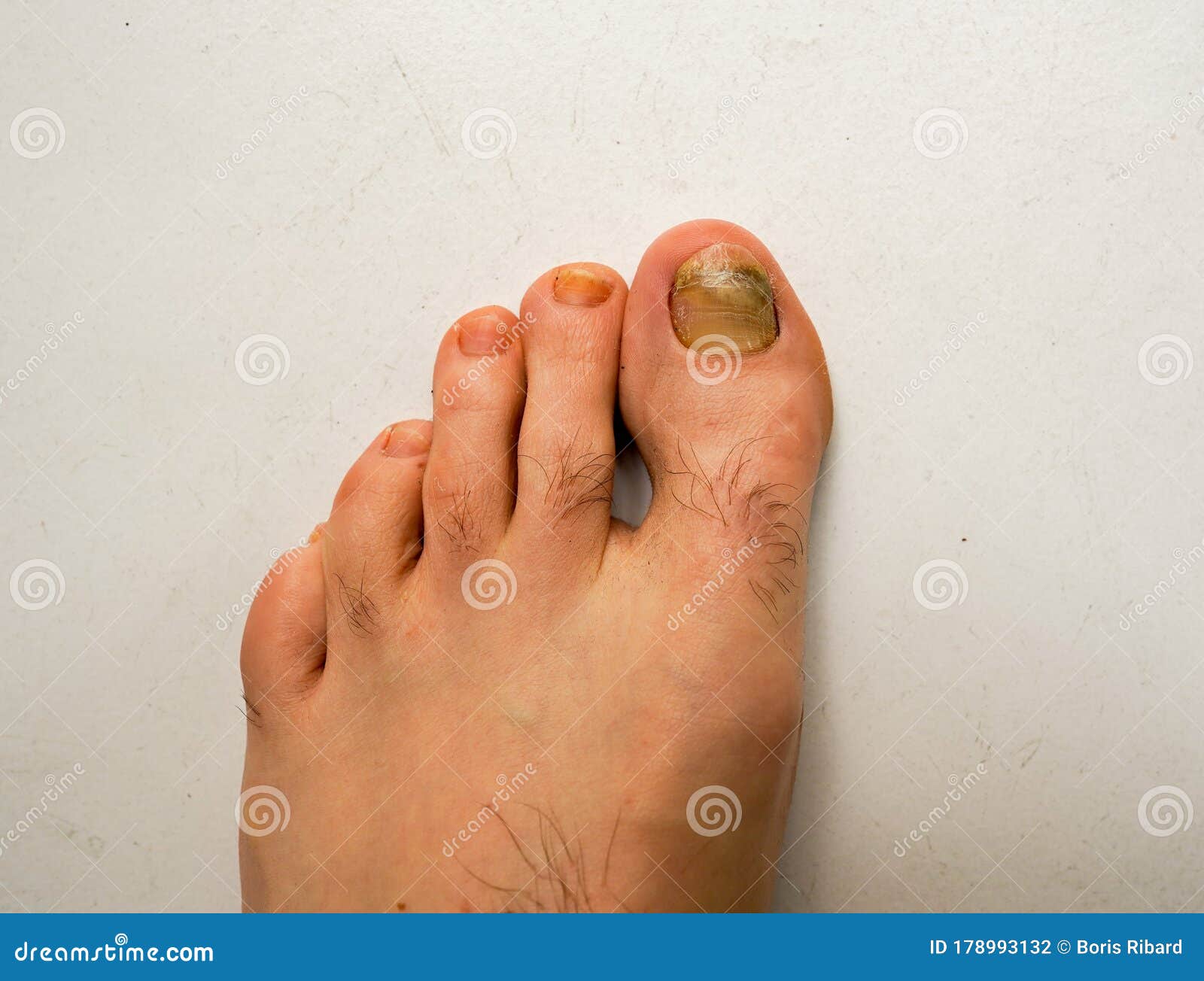 Clavo De Pie Humano Roto Y No Sano Foto de archivo - Imagen de masaje ...