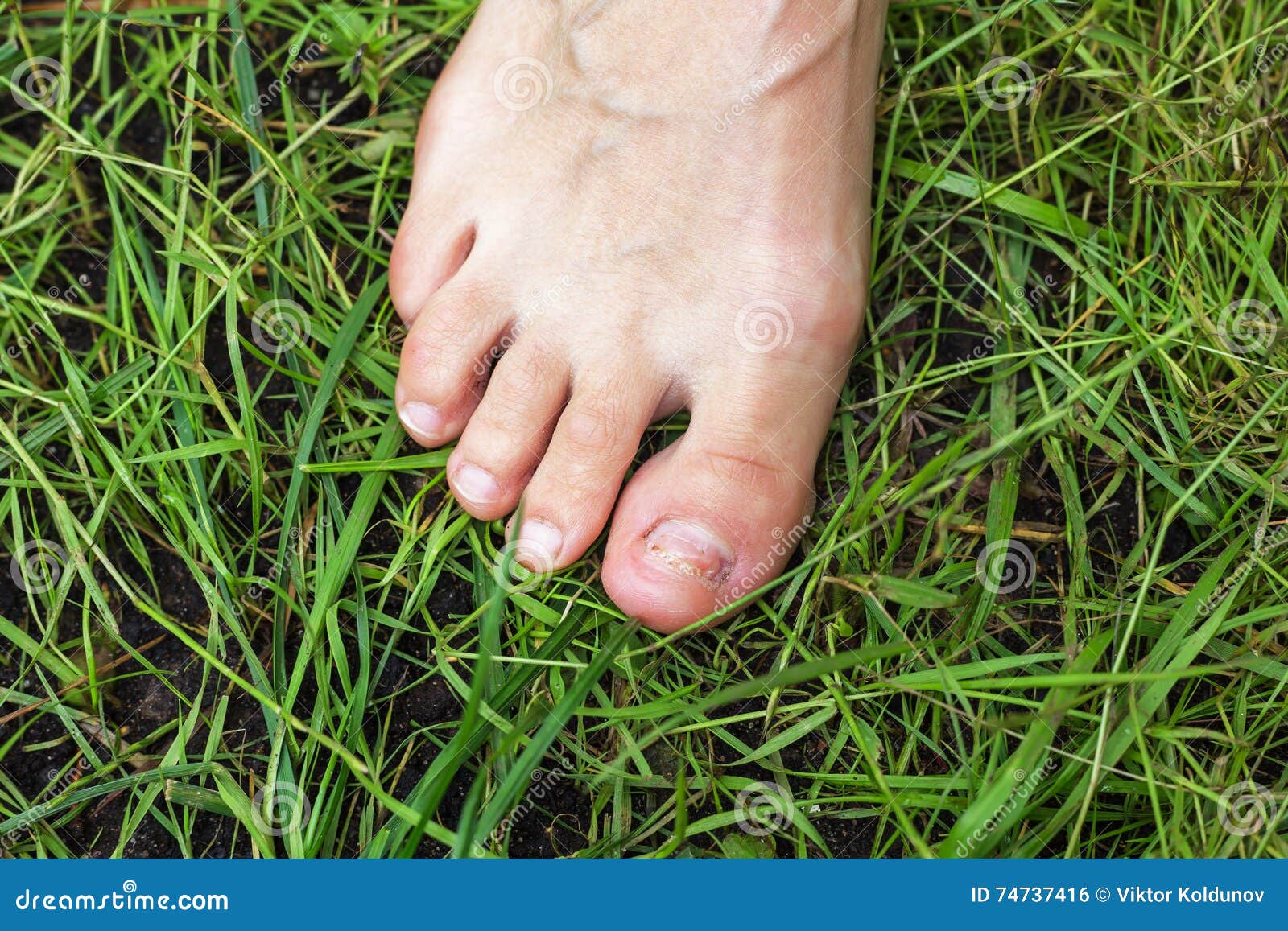 Clavo Quebrado En El Dedo Del Pie Foto de archivo - Imagen de ...