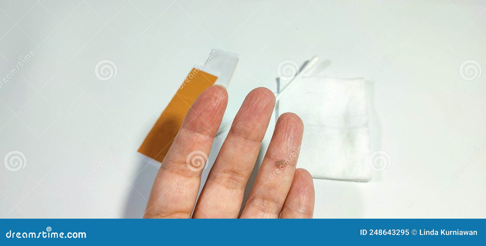 Clavus on a Human Finger. Dermatology Problem Stock Image - Image of ...