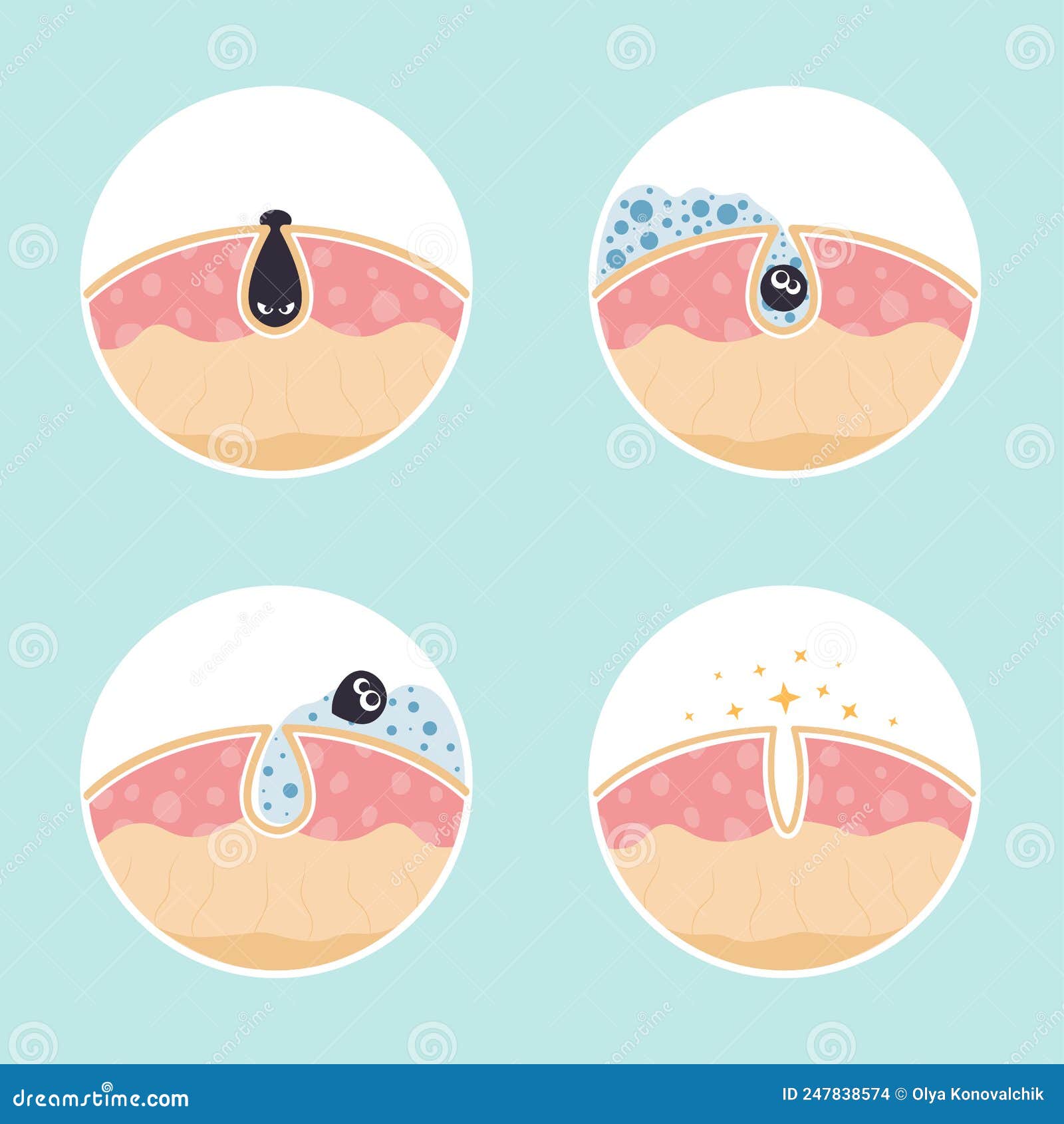 Cleaning Clogged Pores Process Flat Vector Illustration. Steps Of ... Cleaning Clogged Pores Process Flat Vector Illustration. Steps Of ...
