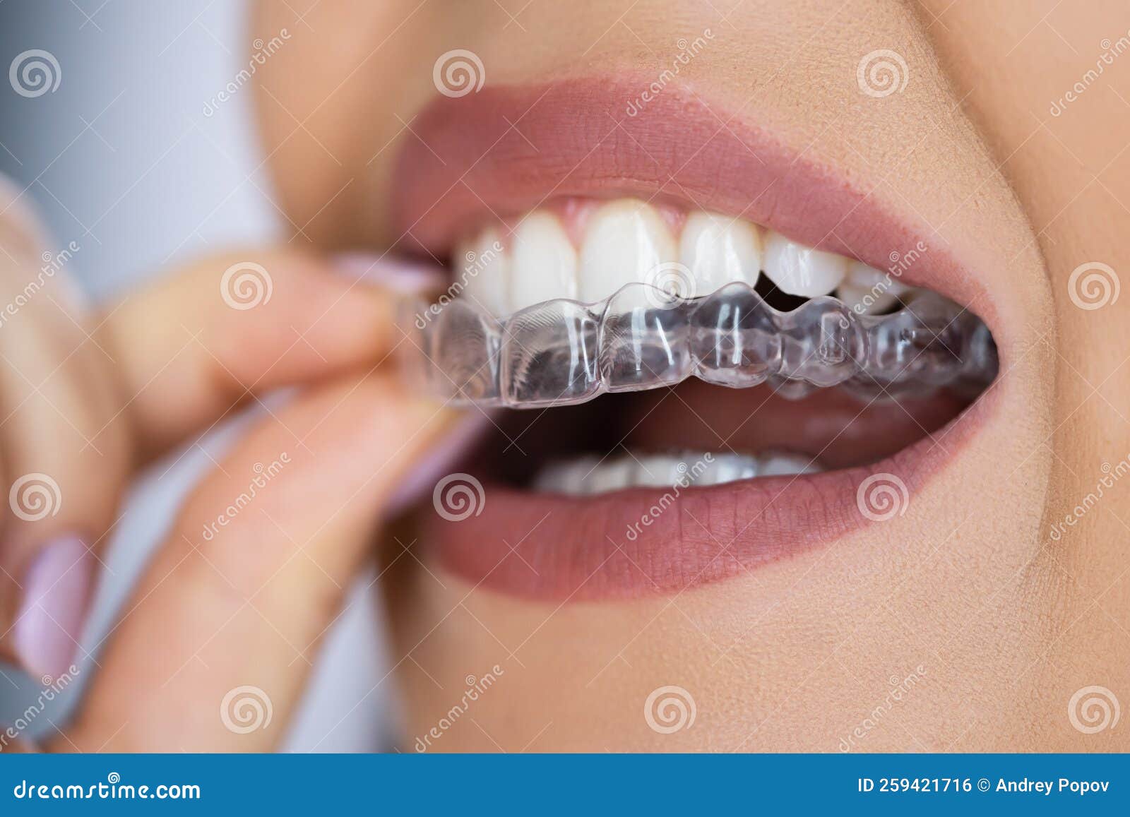 Clear Aligner Dental Night Guard Stock Photo - Image of aligners ...