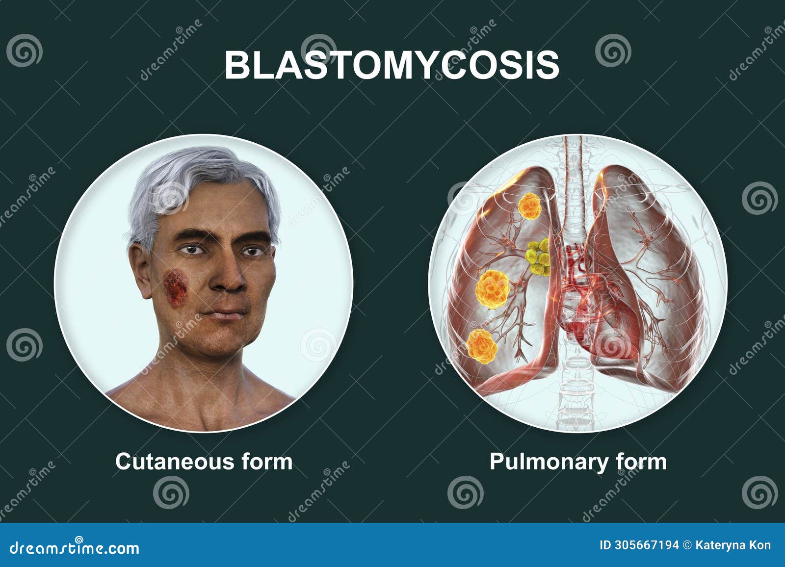 Clinical Forms Of Blastomycosis, 3D Illustration | CartoonDealer.com ...