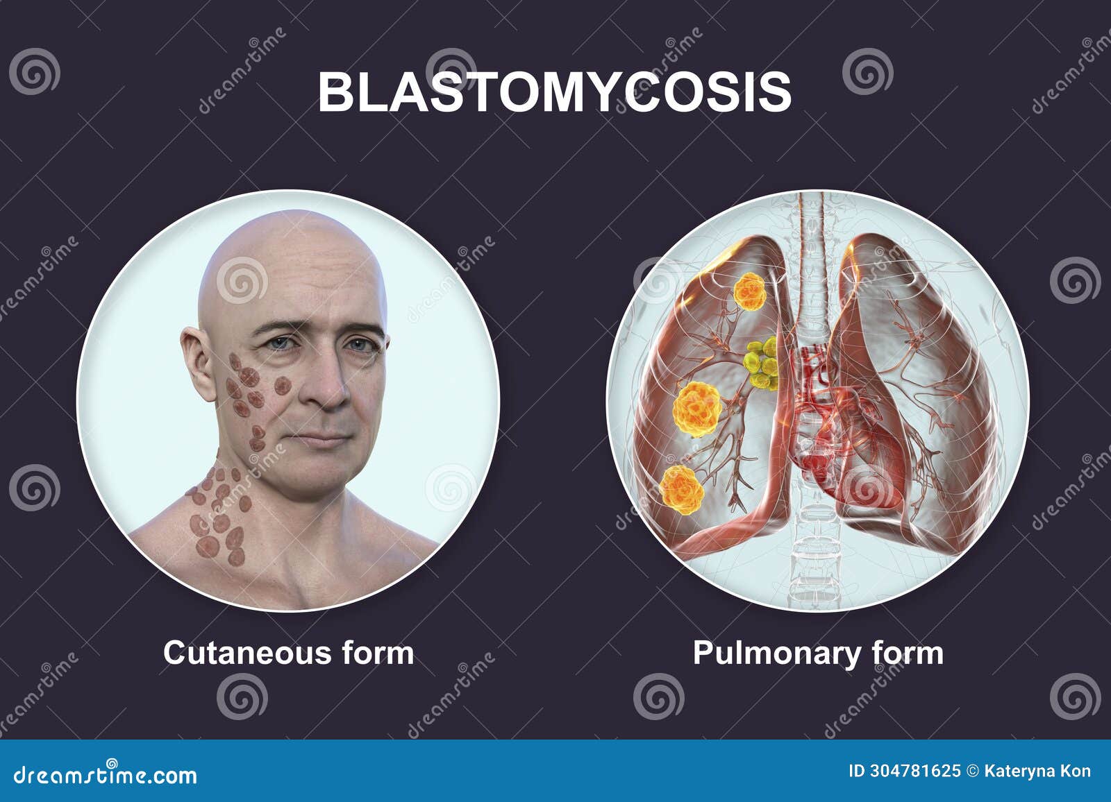 Clinical Forms of Blastomycosis, 3D Illustration Stock Illustration ...