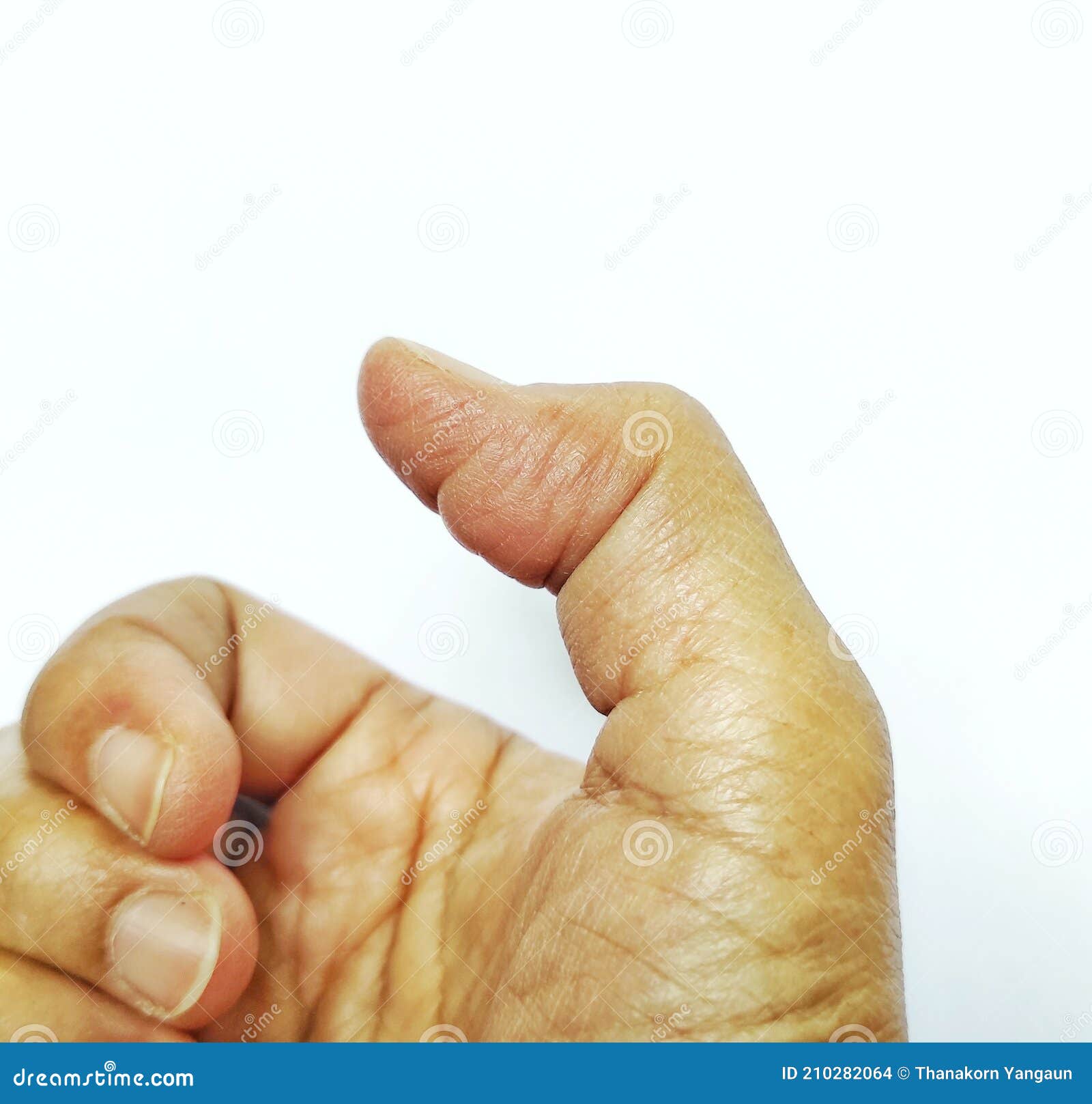Clinical of Trigger Finger Right Thumb in Patient in Hospital. Stock ...