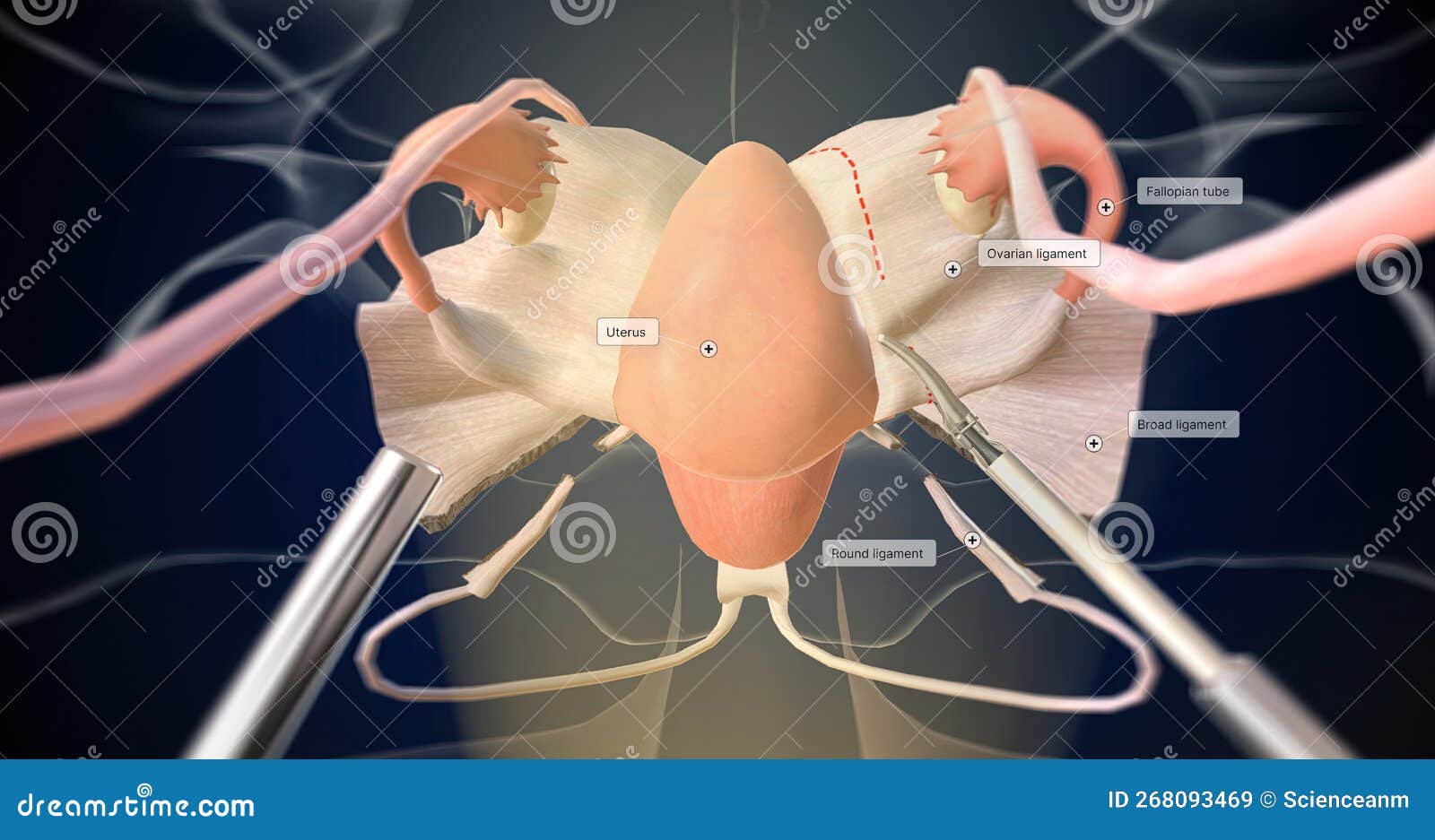 Clipping and Ligating of Fallopian Tubes and Ovarian Ligaments Stock ...