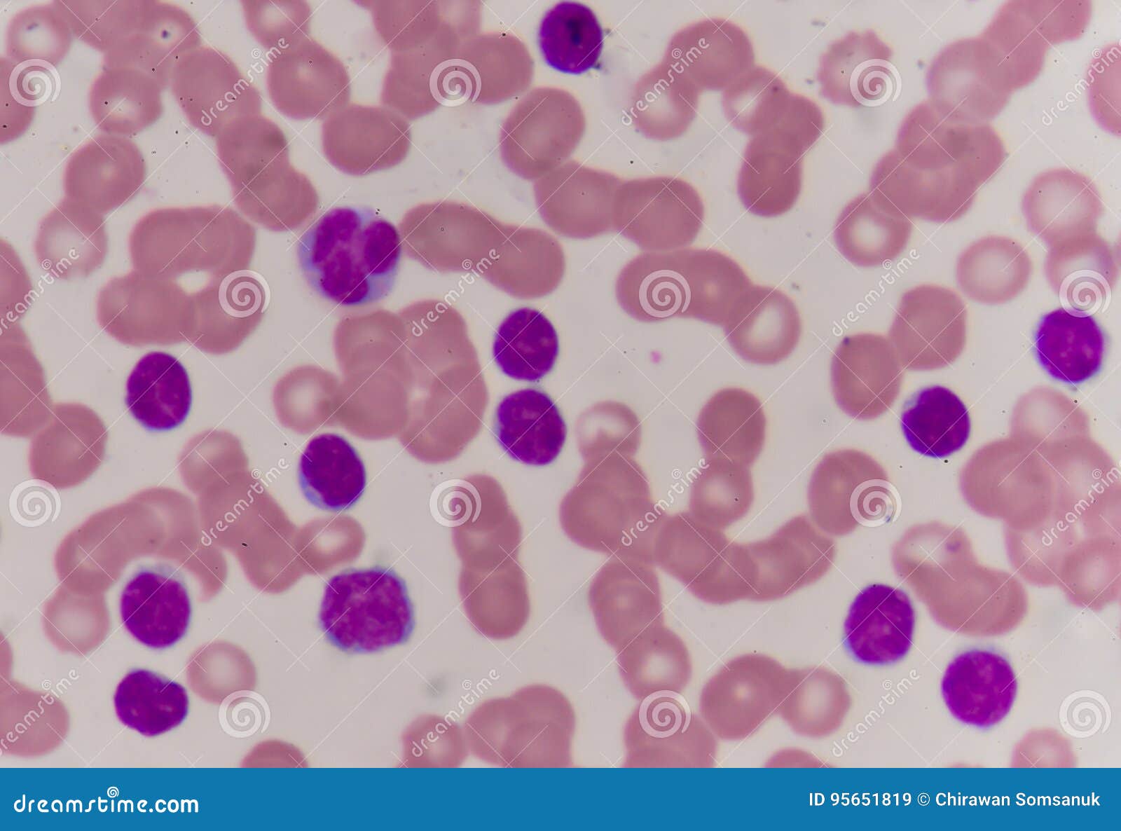 CLL blood smear stock image. Image of diagnosis, leukemia - 95651819