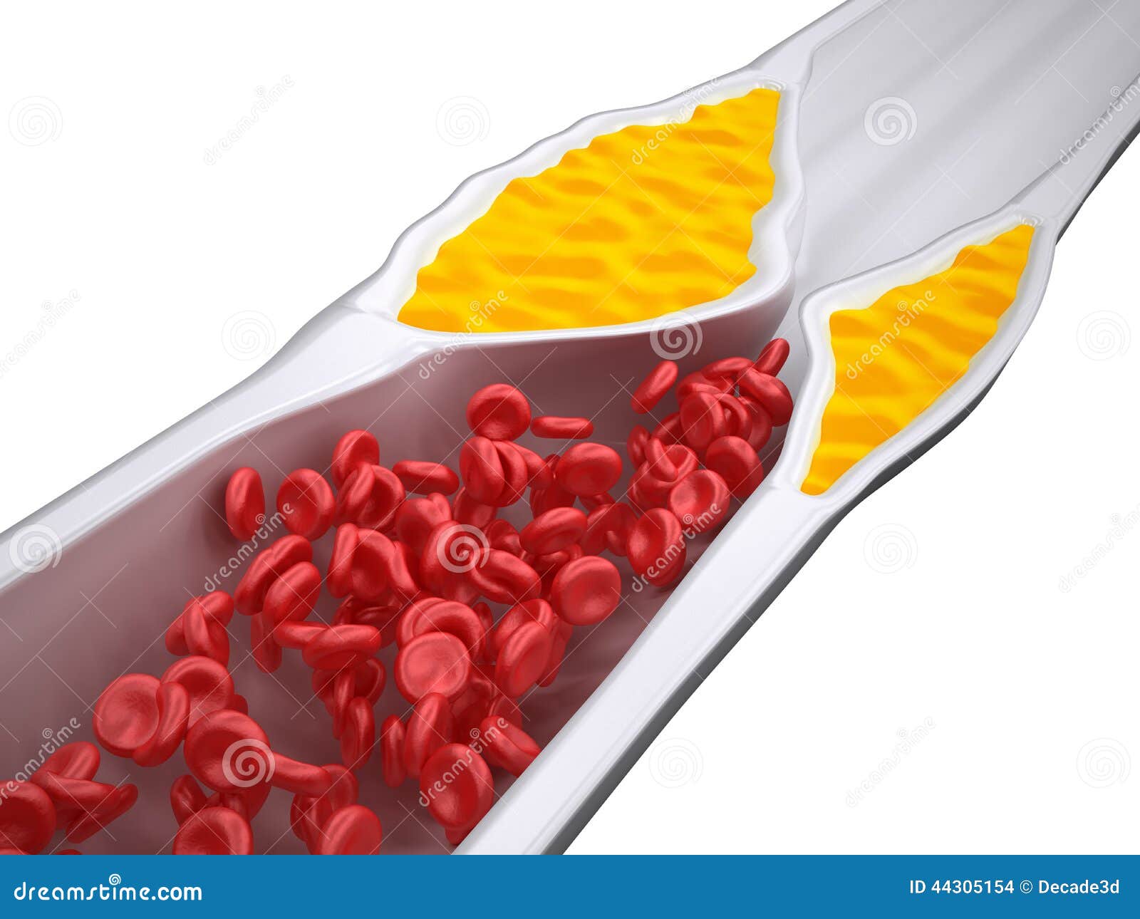 Clogged Artery - Atherosclerosis / Arteriosclerosis - Cholesterol ...