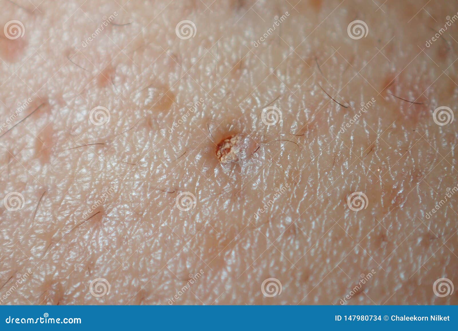 Clogged Pores from Cosmetics, Stock Photo - Image of beauty, woman ...