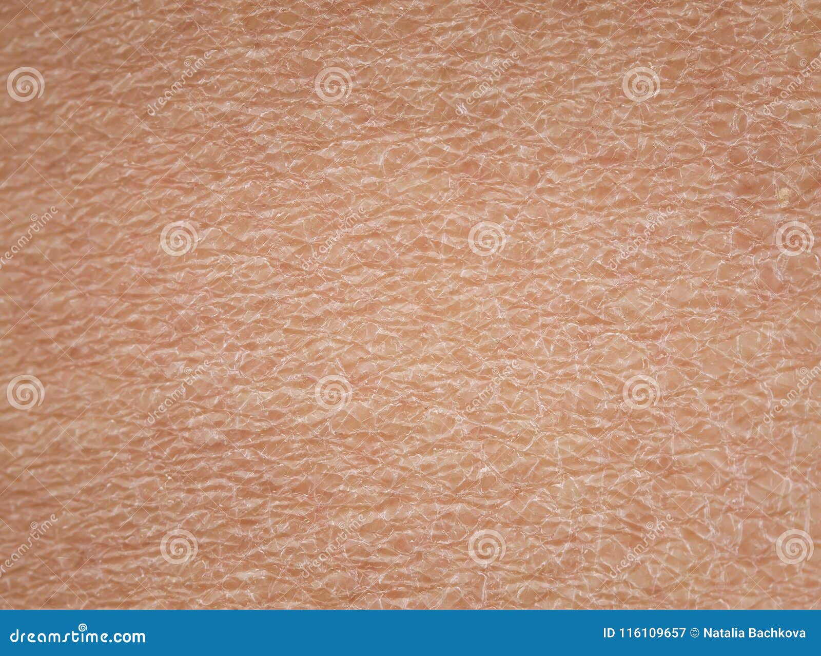 Close Human Skin with Dermatological Problems of Dryness Stock Image ...
