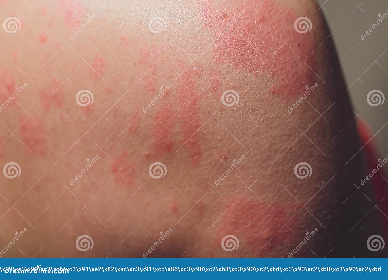 Close Up Allergy Rash Around Back View Of Human With Dermatitis Problem Of Rash Allergy Rash