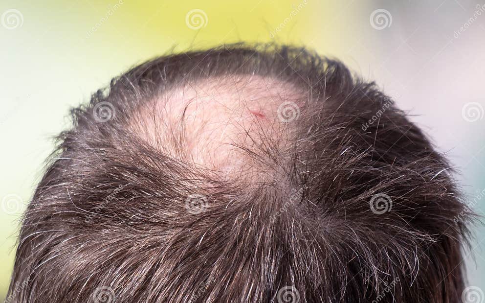 Close-up of a Bald Patch on a Man S Head Stock Image - Image of ...