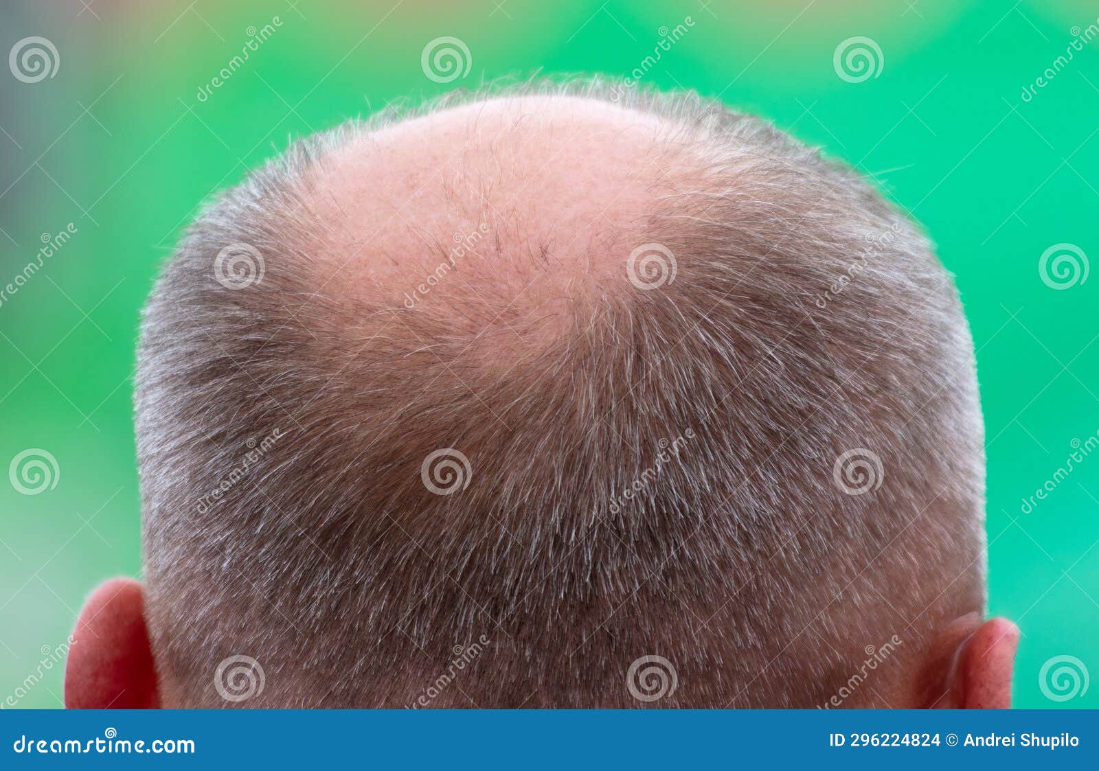 Close-up of a Bald Patch on a Man S Head Stock Photo - Image of human ...