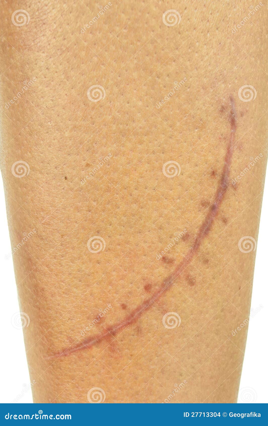 Close-up of a Big, Fresh Scar Stock Photo - Image of treatment, hurt ...