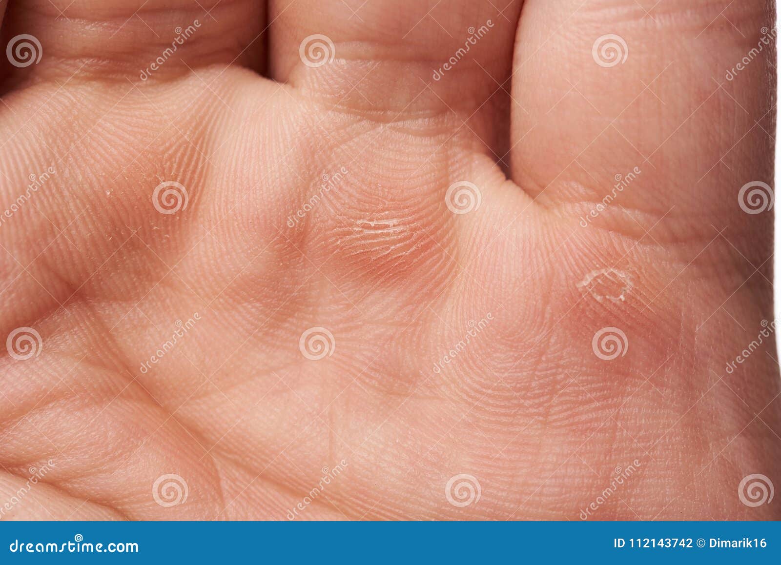 Close-up of Blister on Human Hand Stock Photo - Image of injured, dirty ...