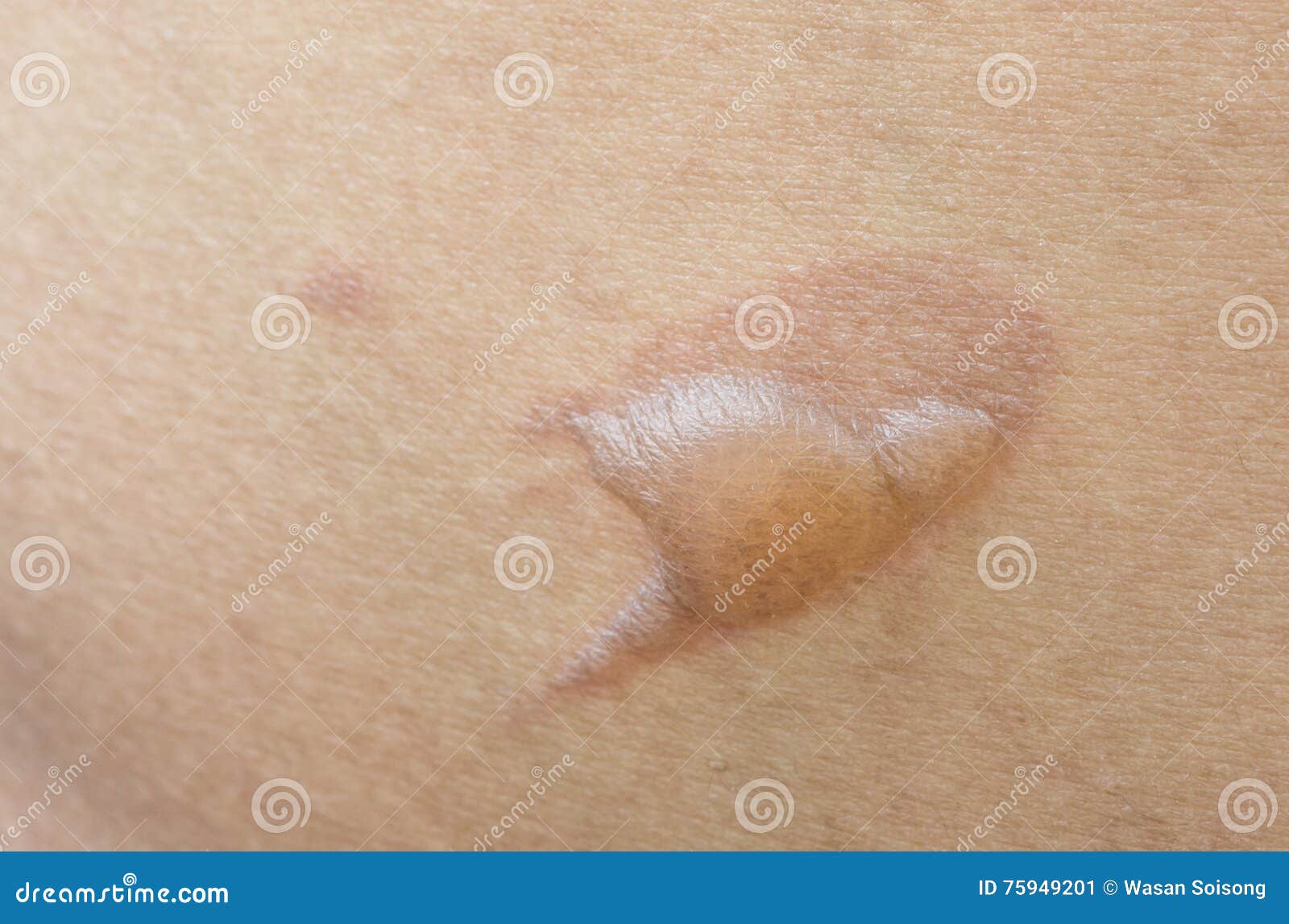 Close Up Blister from Scald on the Skin Stock Image - Image of burn ...