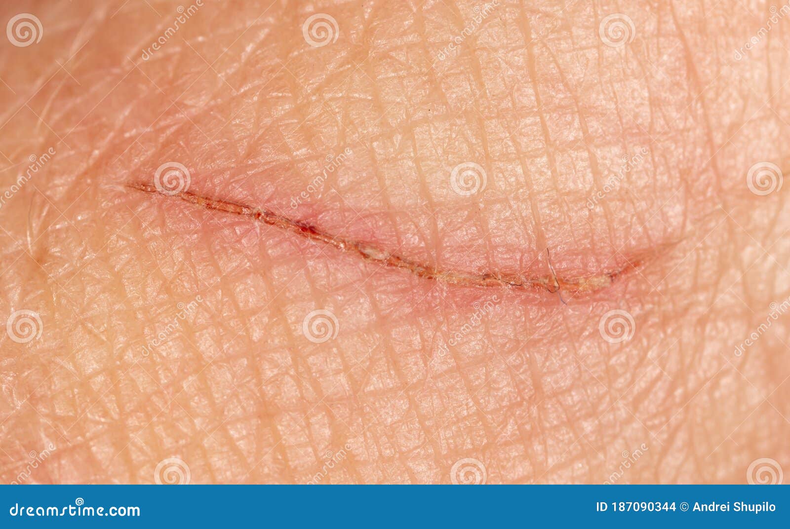 Close-up of Blood from a Wound on a Human Skin Stock Photo - Image of ...