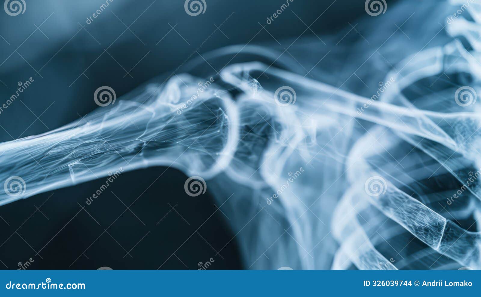 Close-Up X-Ray Image of a Human Shoulder Joint Stock Photo - Image of ...