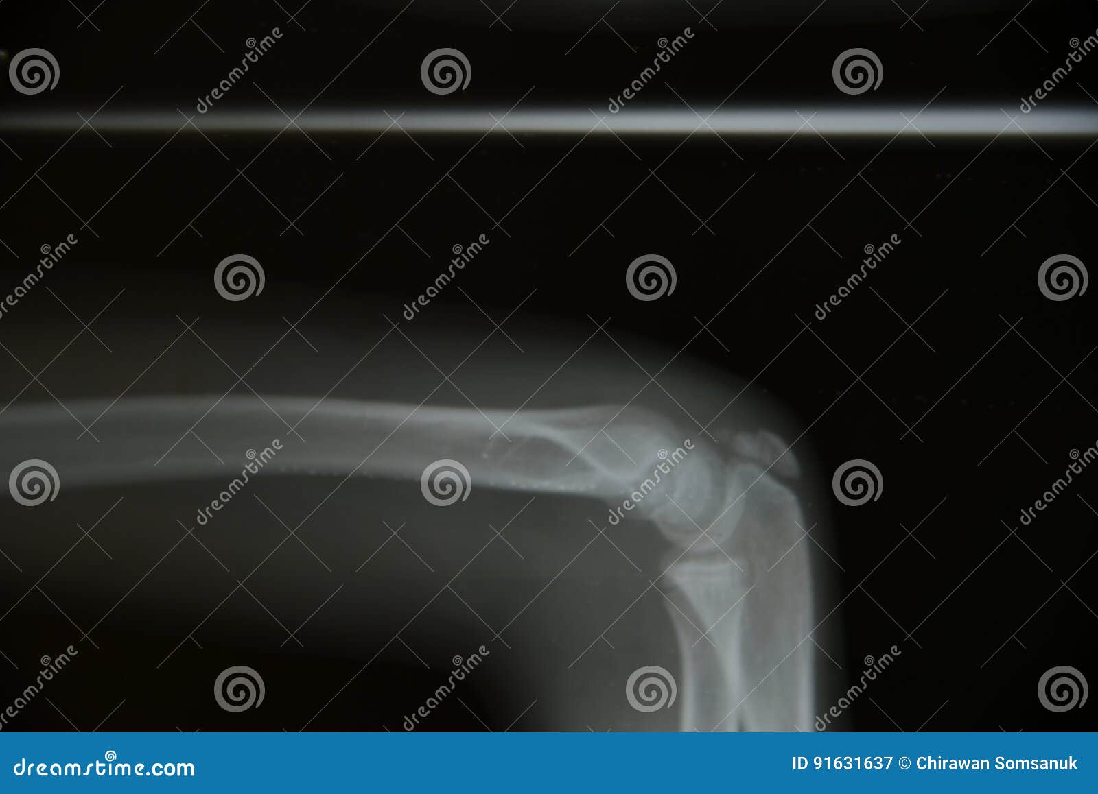 Close Up Bone X-ray Medical Stock Image - Image of medicine, body: 91631637