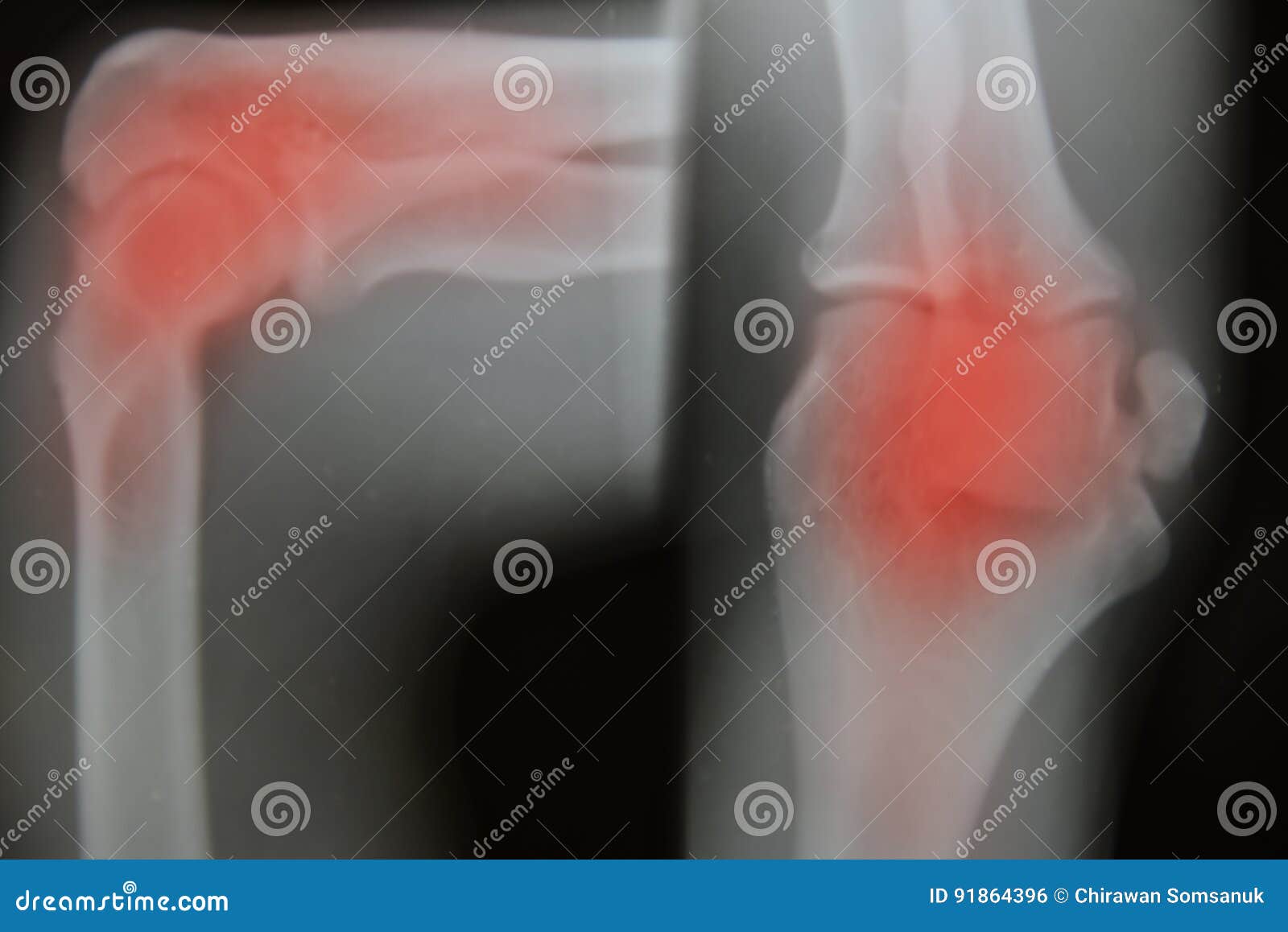 Close Up Bone X-ray Medical Stock Photo - Image of checkup, anatomy ...
