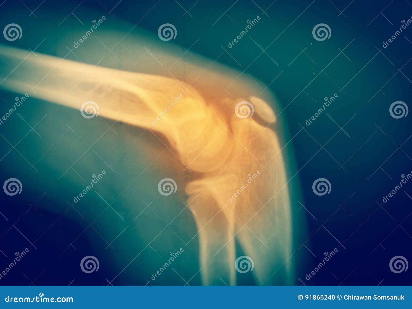 Close up bone x-ray stock photo. Image of health, doctor - 91866240