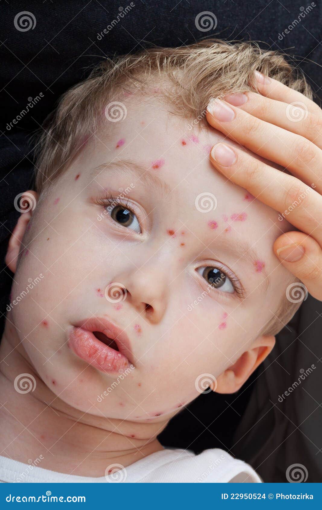 Close Up Boy with Chickenpox Stock Photo - Image of urticaria ...
