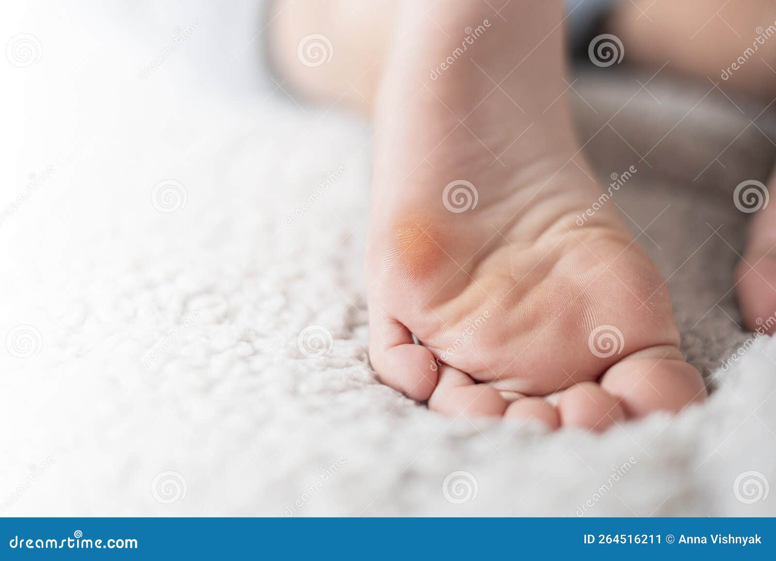 Close Up of Calluses. Problem Skin on the Steps of a Teenager Stock ...