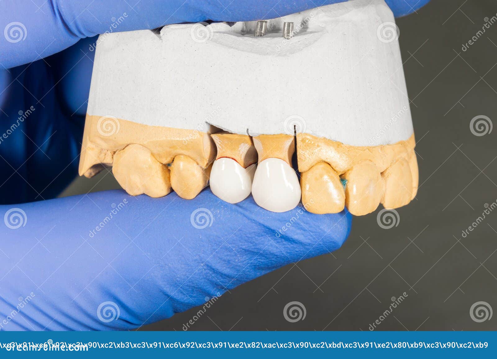 Close-up Ceramic Tooth Crown on a Plaster Model of Teeth in the Dentist ...