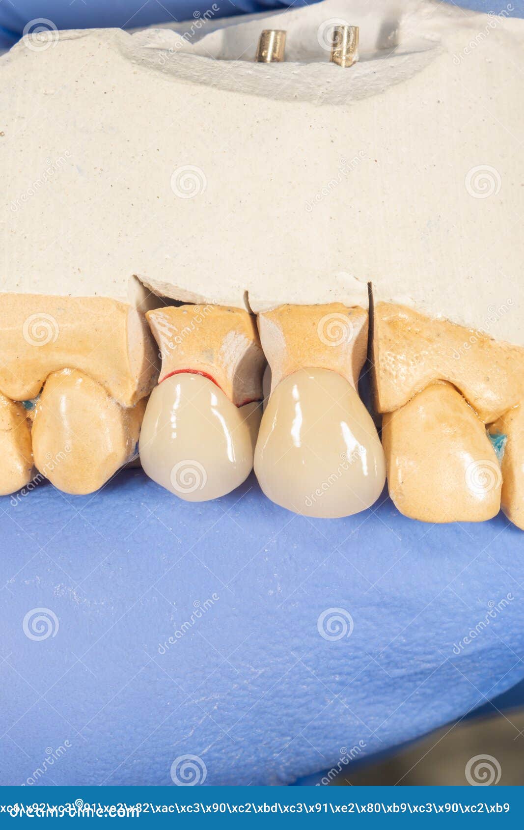 Close-up Ceramic Tooth Crown on a Plaster Model of Teeth in the Dentist ...