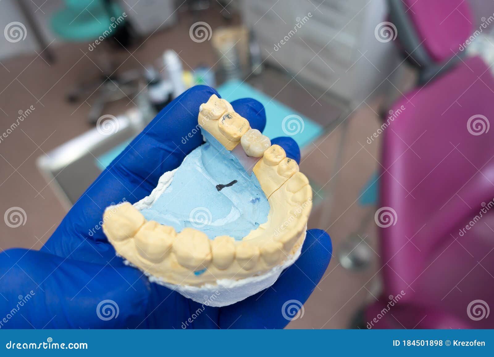 Close-up Ceramic Tooth Crown on a Plaster Model of Teeth in the Dentist ...