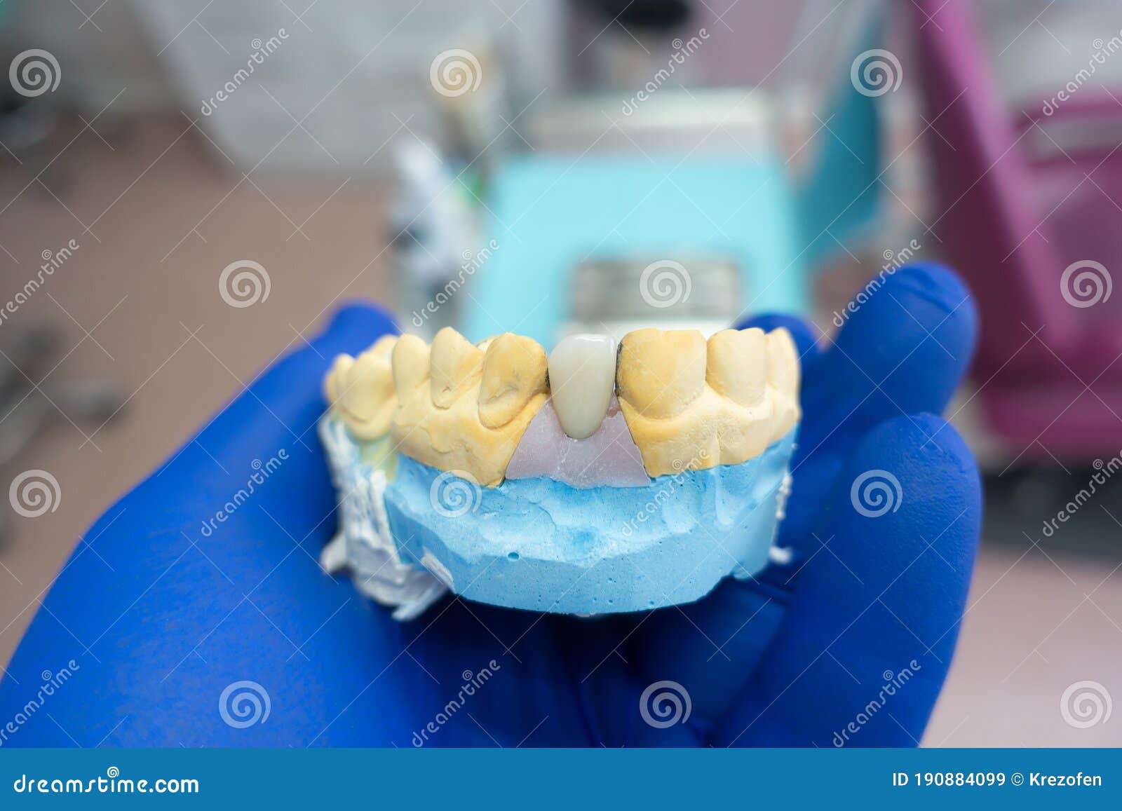 Close-up Ceramic Tooth Crown on a Plaster Model of Teeth in the Dentist ...