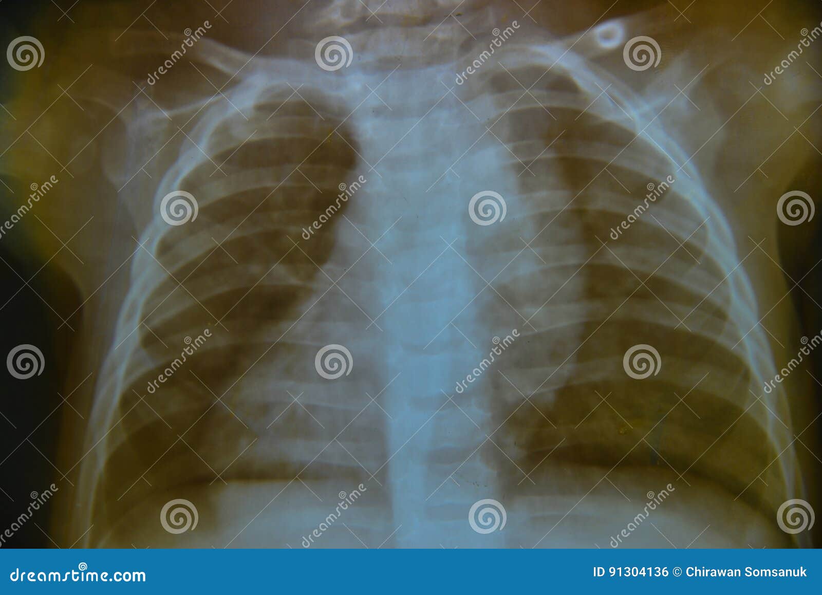 Close up chest child stock photo. Image of anatomy, injury - 91304136