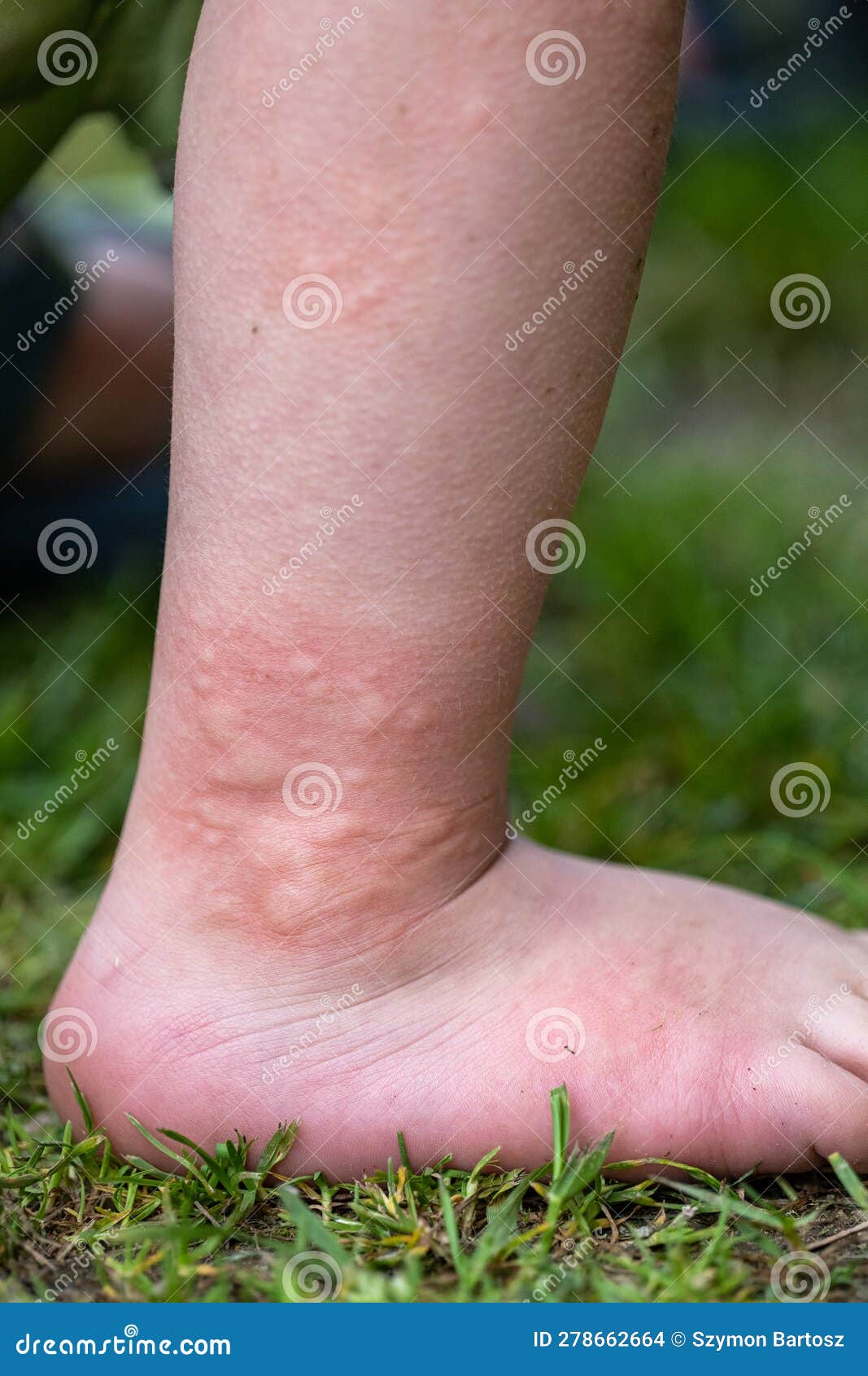 Close-up of a Child S Leg with Stinging Nettle Blisters Stock Photo ...