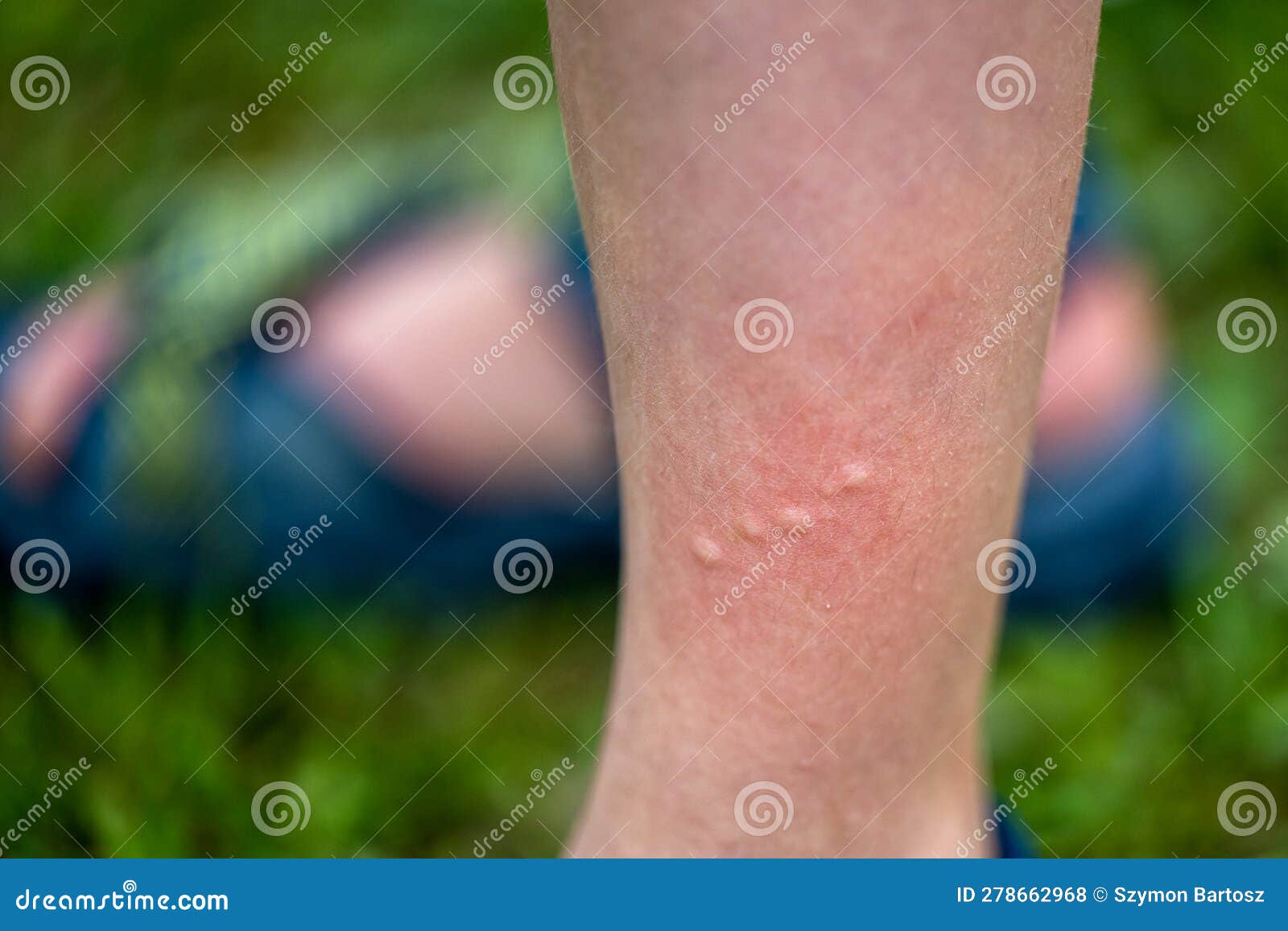 Close-up of a Child S Leg with Stinging Nettle Blisters Stock Photo ...