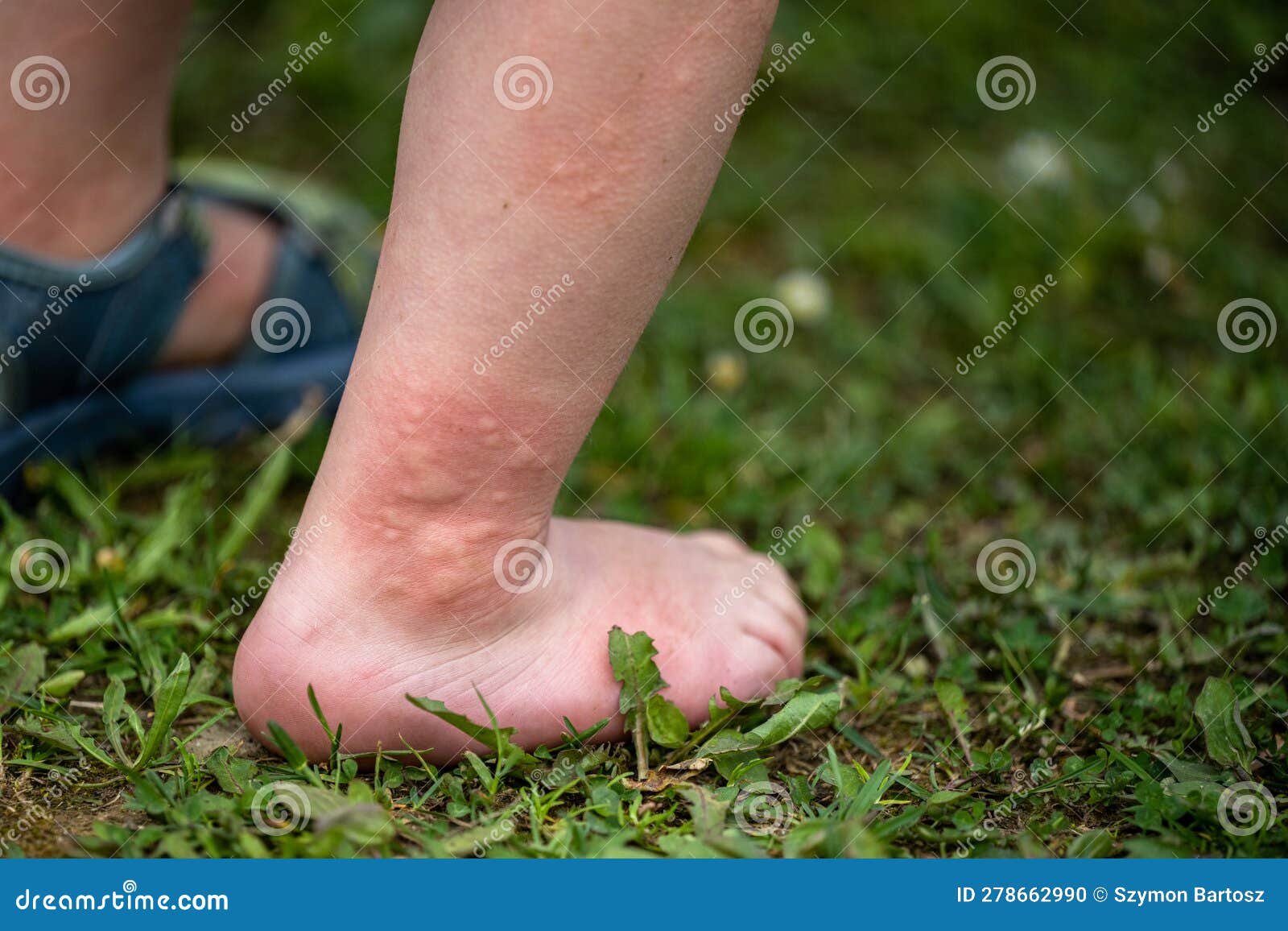 Close-up of a Child S Leg with Stinging Nettle Blisters Stock Photo ...