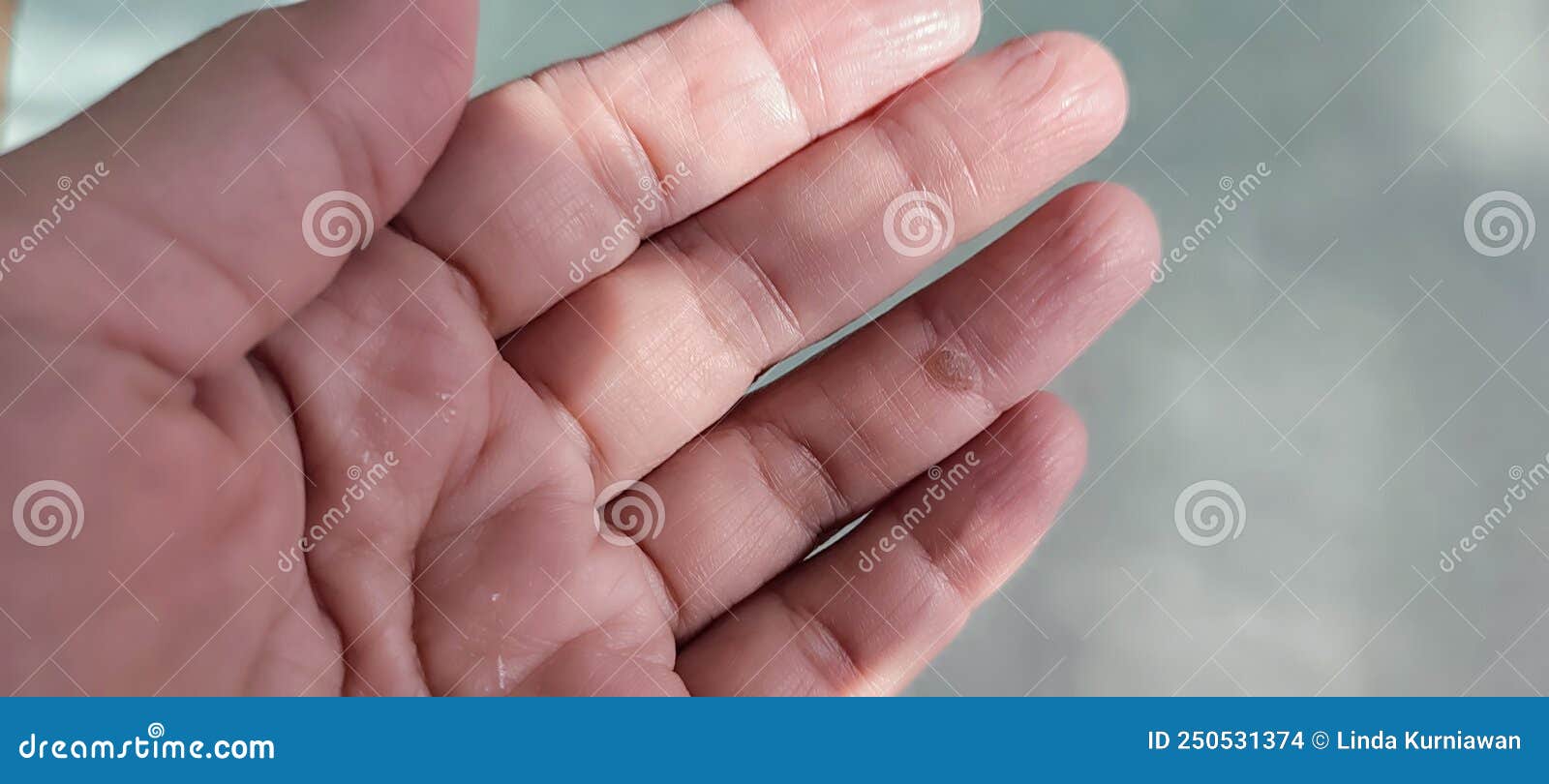 Close Up of Clavus or Corn on Finger. Dermatology Problem Stock Photo ...