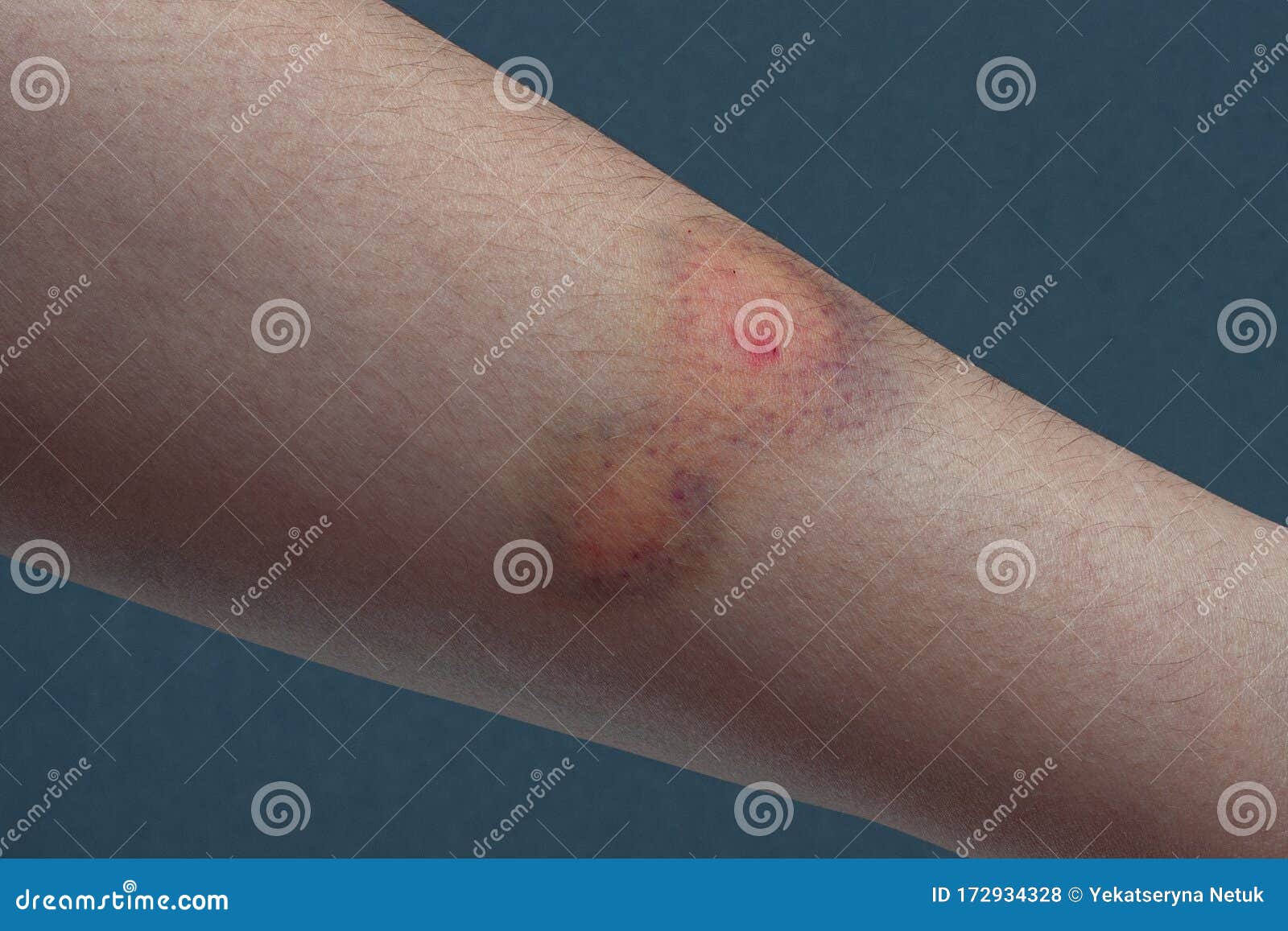 Close Up of a Colored Bruise on a Woman Arm Stock Photo - Image of ...