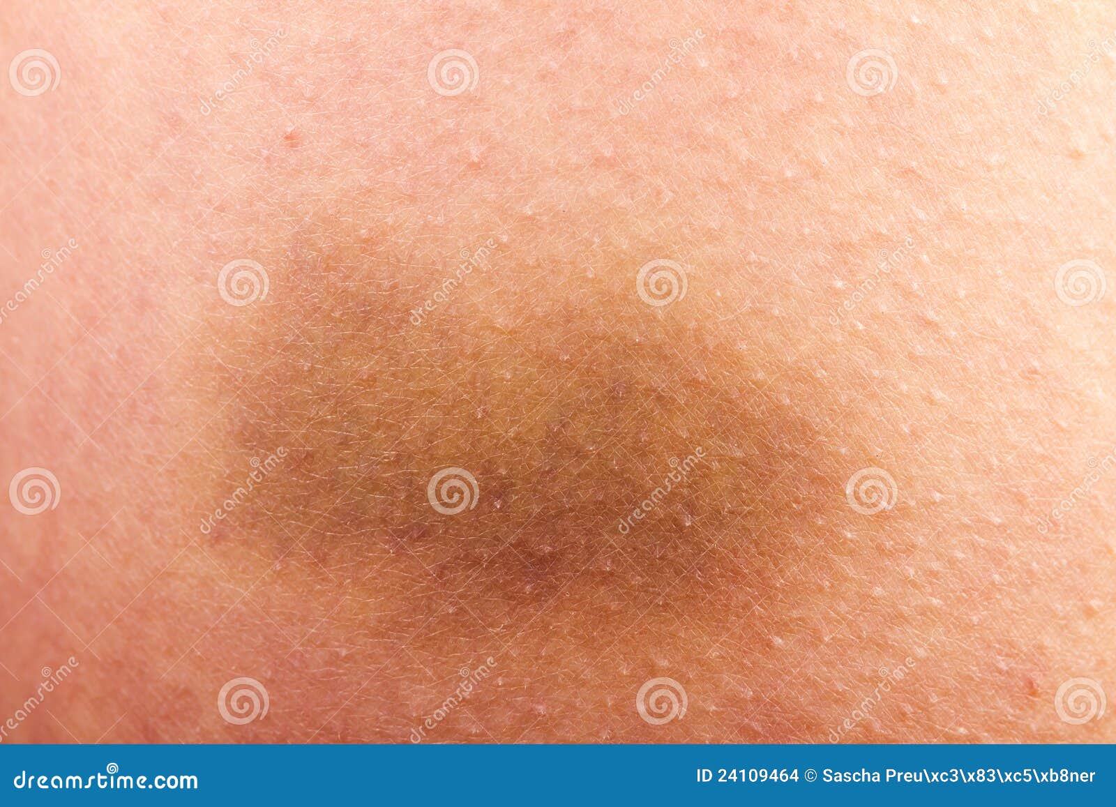 Close up da equimose foto de stock. Imagem de coxa, machucado - 24109464