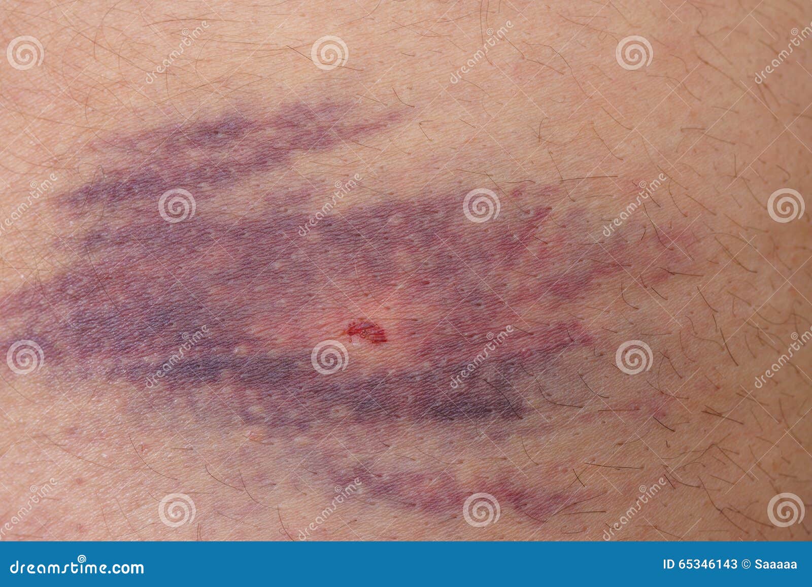 Close Up Da Equimose Sobre a Pele Branca Imagem de Stock - Imagem de ...