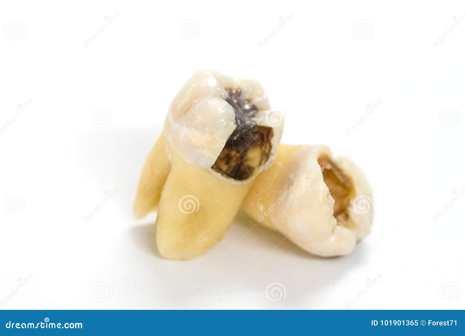 Decayed Tooth on White Background Stock Image - Image of extraction ...