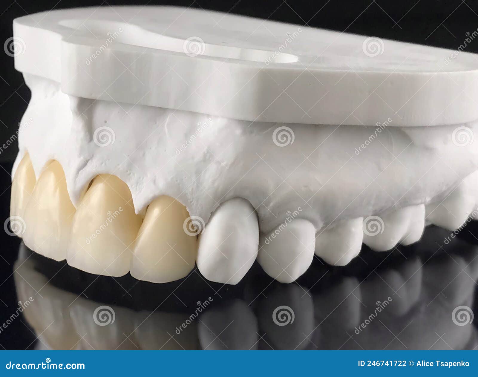 Close-up of Dental Prosthesis Porcelain Teeth in a Mold. Dental ...