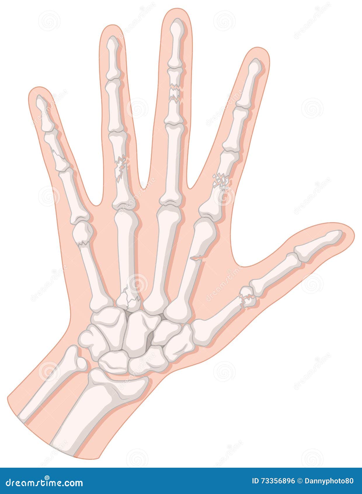 Hand Fracture Stock Illustrations – 5,284 Hand Fracture Stock ...