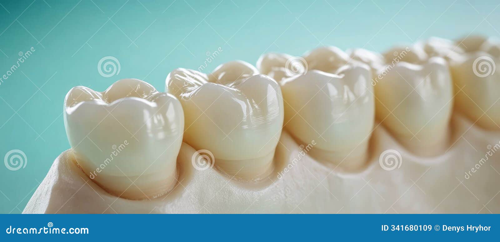 A Close-up Display of Dental Implants Designed To Replicate Natural ...