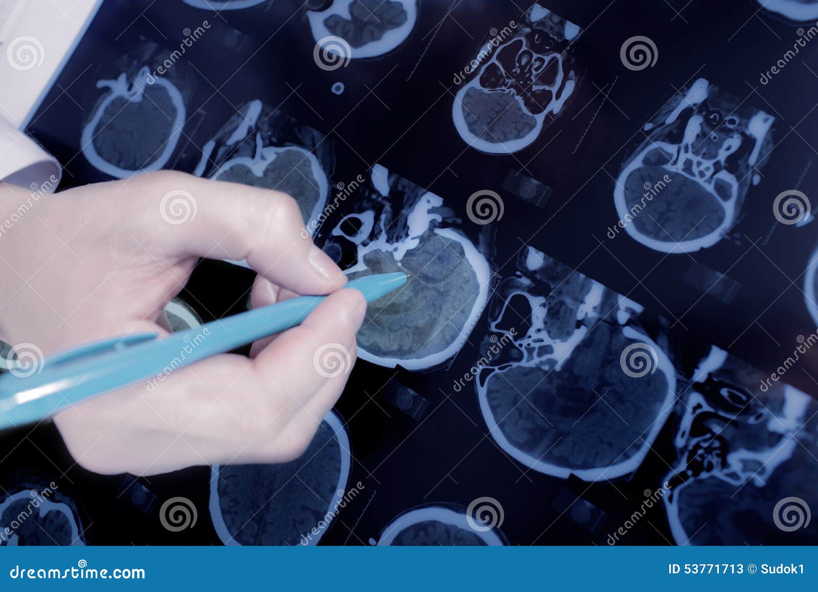 Close-up of the Doctor Hand Pointing To the CT Stock Image - Image of ...