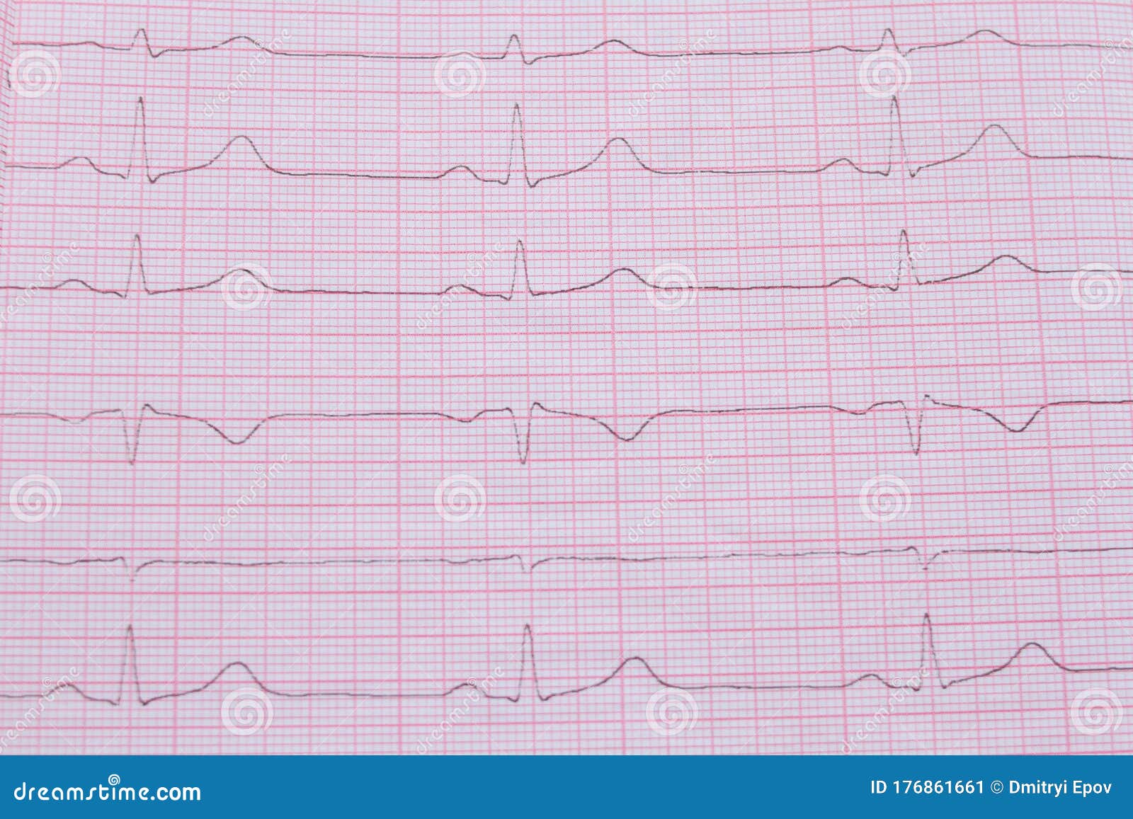 Close Up Of Ecg Cardiogram Pulse Graph On A Paper Medical Examination