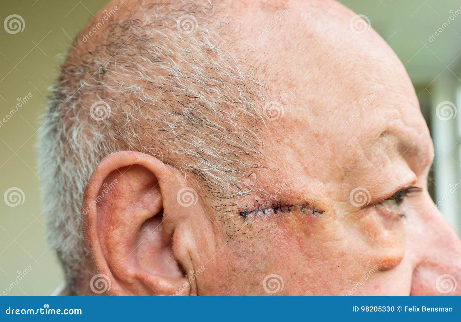 Close-up of Elderly Man Face with Edema after Surgery Stock Photo ...