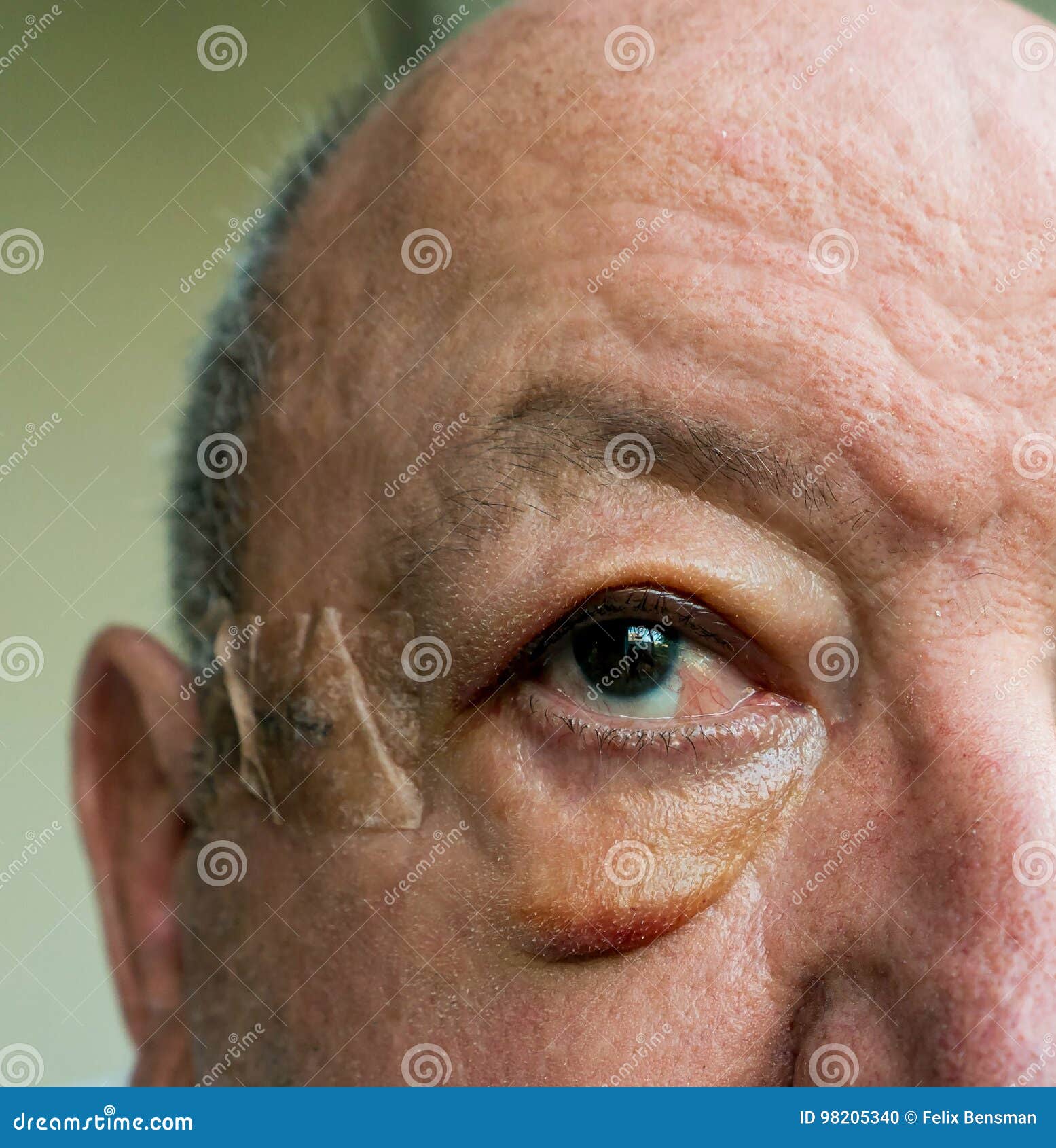 Close-up of Elderly Man Face with Edema after Surgery Stock Photo ...