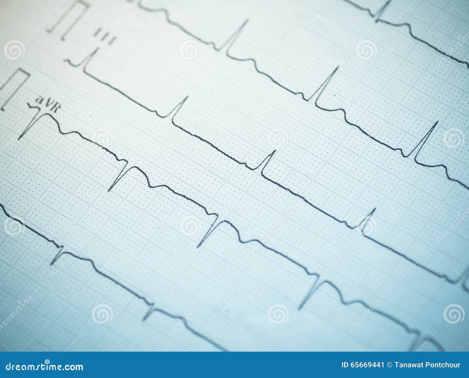 Close Up Of An Electrocardiogram In Paper Form. ECG Or EKG Record Paper ...